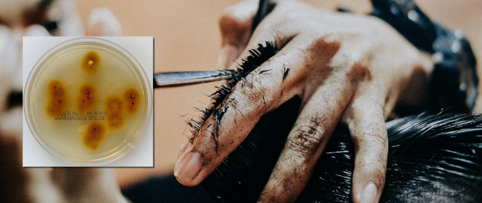 Qué es la tiña de la cabeza, qué síntomas tiene y cómo se trata esta ...